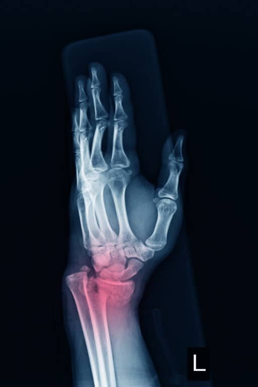 Fracture du poignet - Dr Maxime Rousié