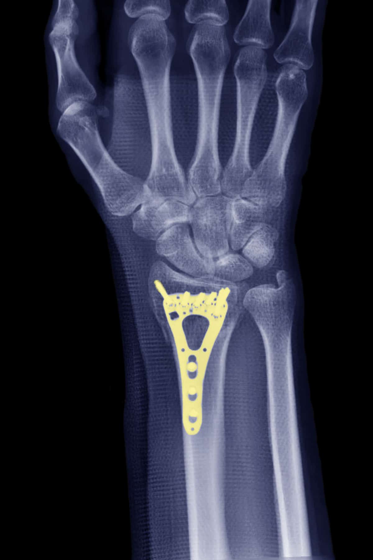 Fracture du poignet - Dr Maxime Rousié
